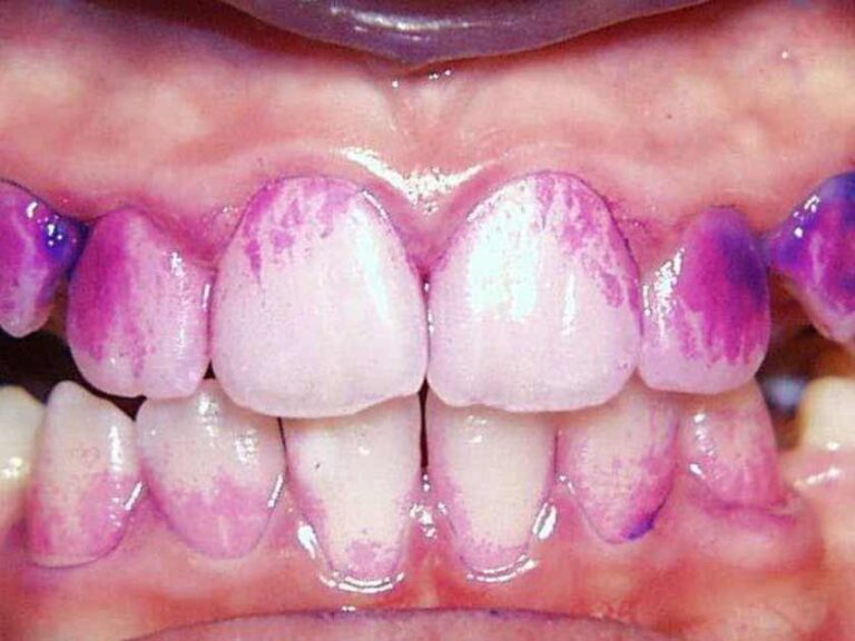 Young disclosing solutions and disclosing tablets: Modern prophylaxis